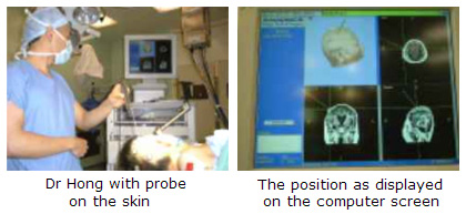 Stereotactic Craniotomy - eMenders Medical Specialist